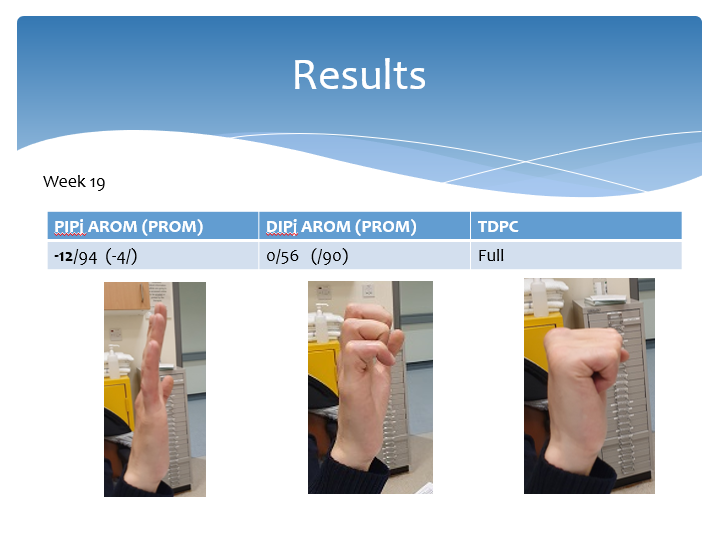 Treatment Case Study for Proximal Interphalangeal (PIPJ) Joint Flexion ...